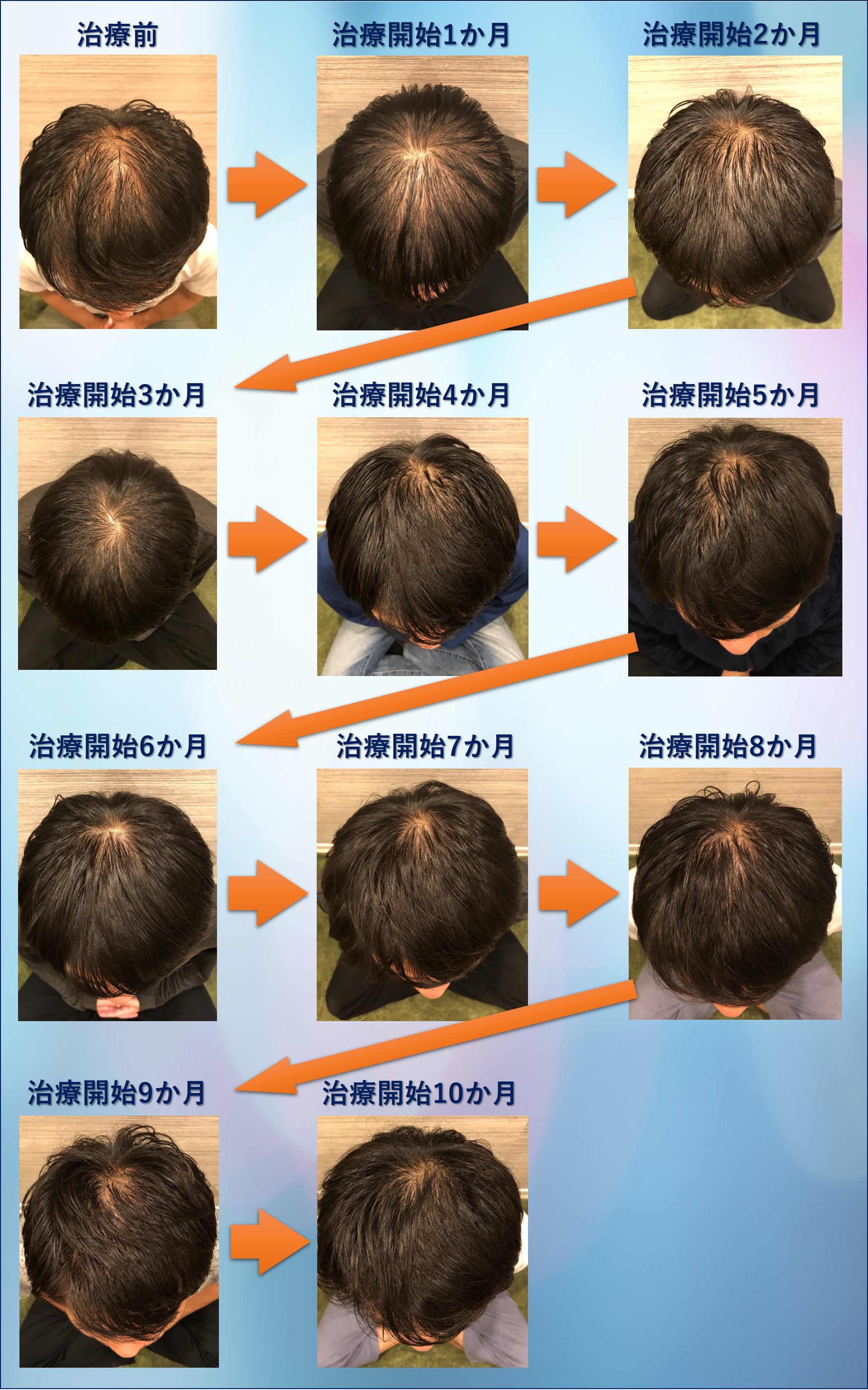 【AGA治療10か月目】俺は一生治療を続ける！？現代医学の限界 | 若ハゲ彼氏のAGA治療
