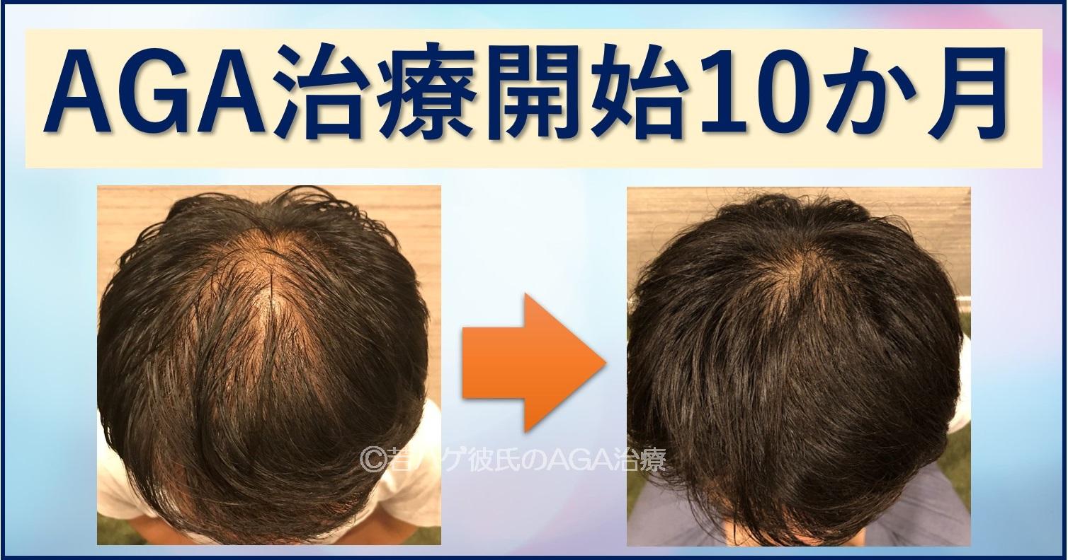 【AGA治療10か月目】俺は一生治療を続ける！？現代医学の限界 | 若ハゲ彼氏のAGA治療